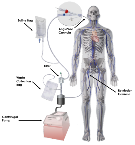 The Use of AngioVac in Right-Sided Infective Endocarditis | STS